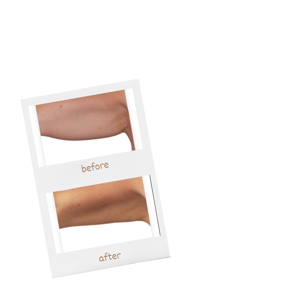 SKIN TIGHTENING - York3dlipoclinic